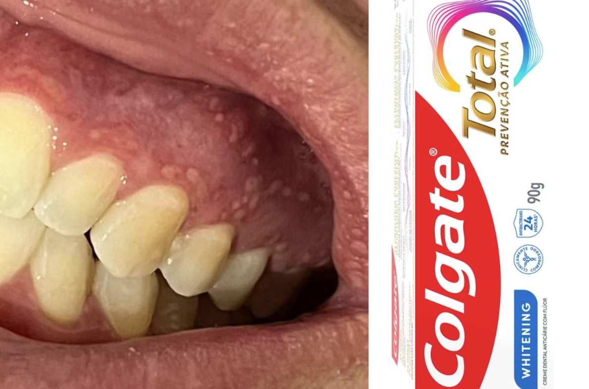 Anvisa volta atrás e mantém suspensão de pasta da Colgate | aRede